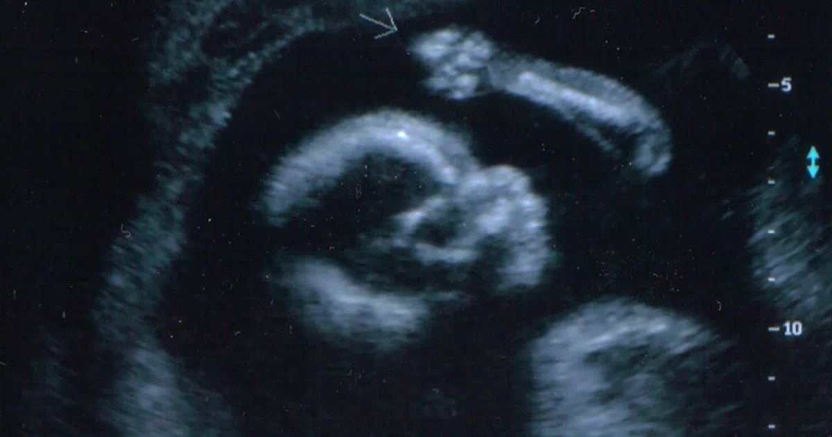 Ultrasound Shows Baby Giving Mom The Finger | Y94